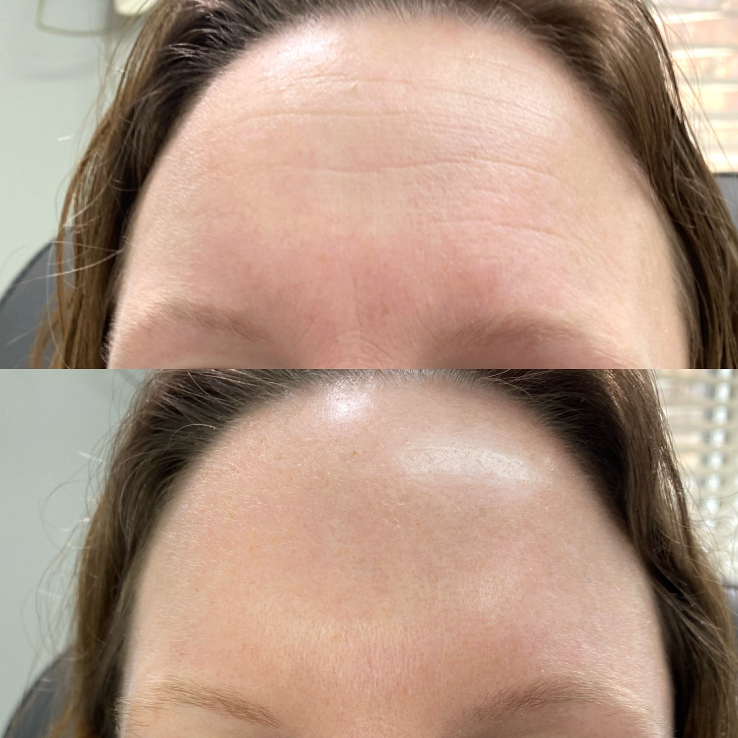 Botox Cosmetic Injections, Dysport Injections | Roscoe, IL | Radiance ...